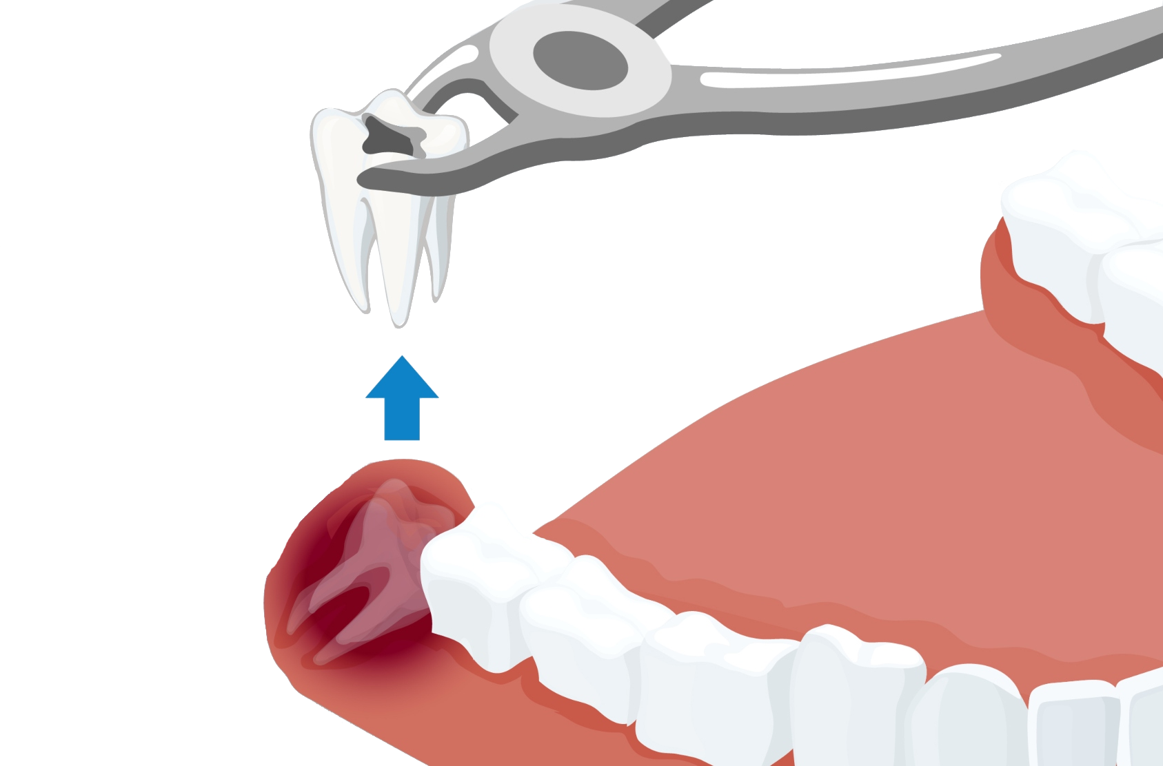 wisdom-teeth-dentist-doncaster